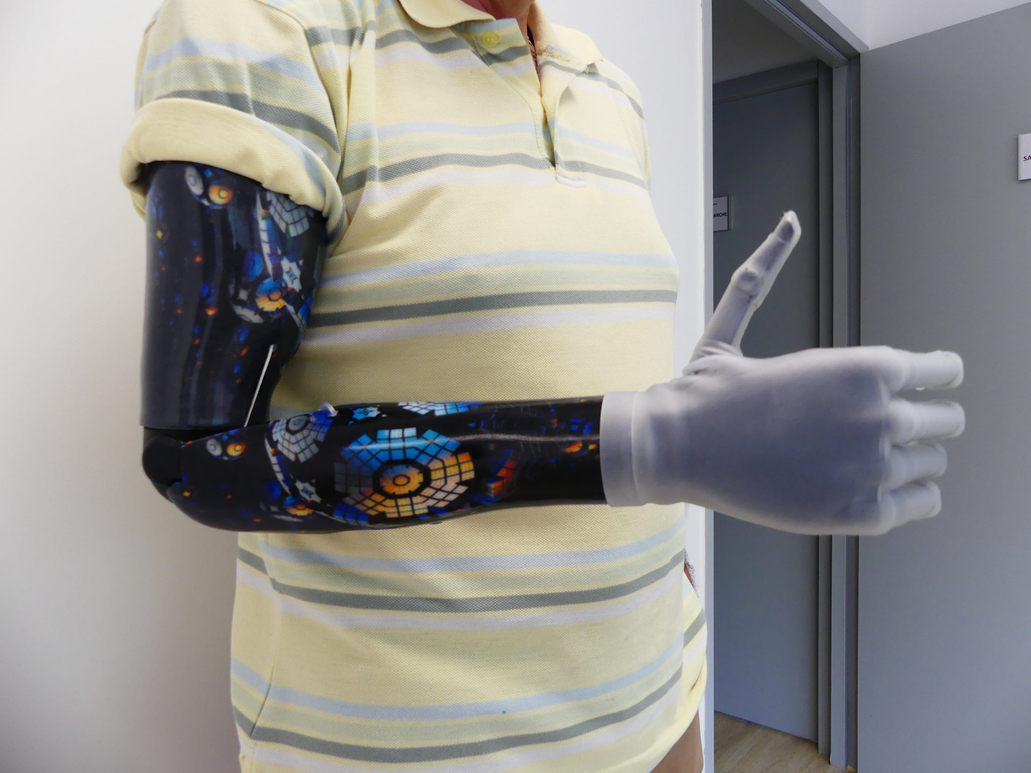 Prothèse pour membre amputé à Toulouse | Ortho-Evolution